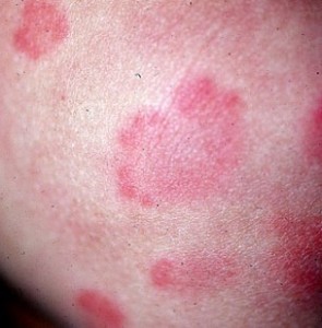 Dog Dander Allergy Rash